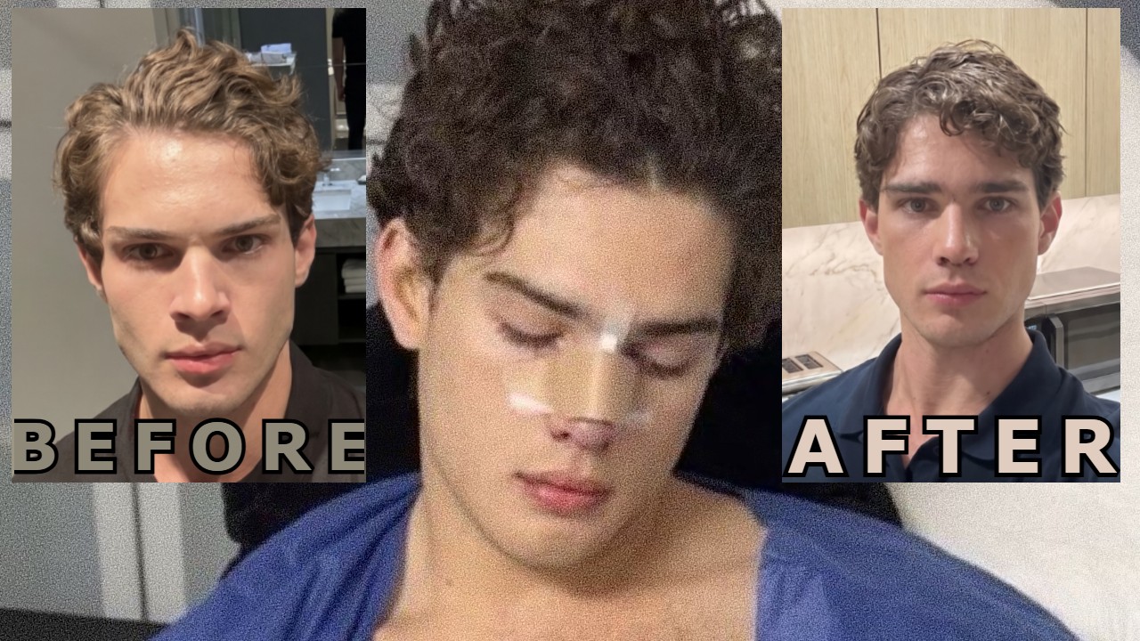 Clavicular's Nose Job | Know Your Meme