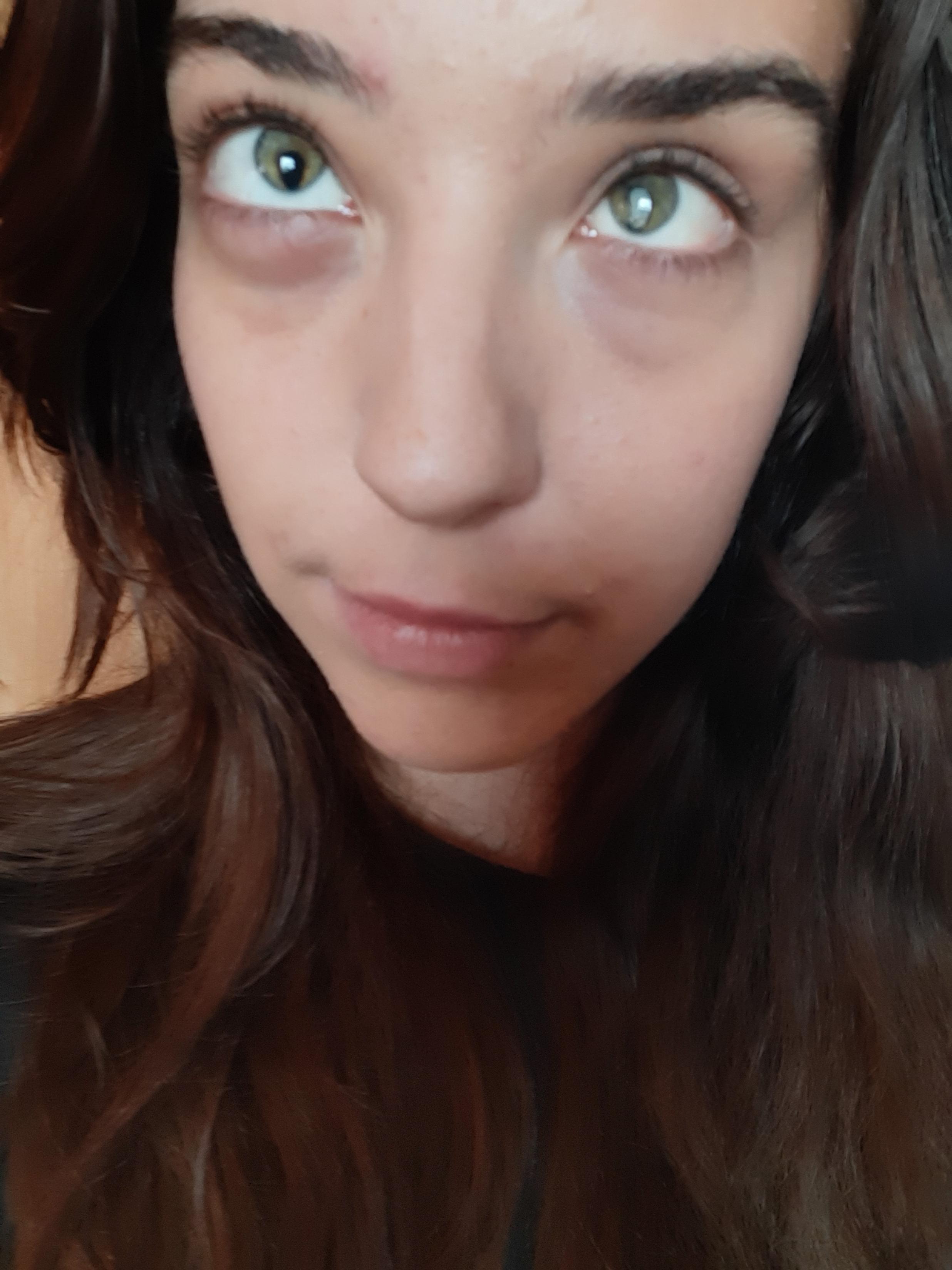 I Have Bilateral Coloboma And Am Blind In One Eye no Points For