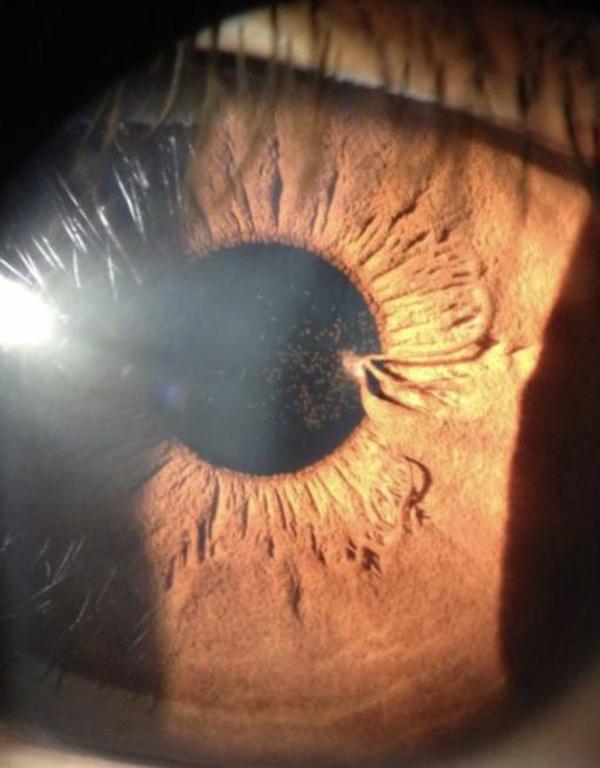 My left eye being invaded by my iris | /r/mildlyinteresting | Mildly ...