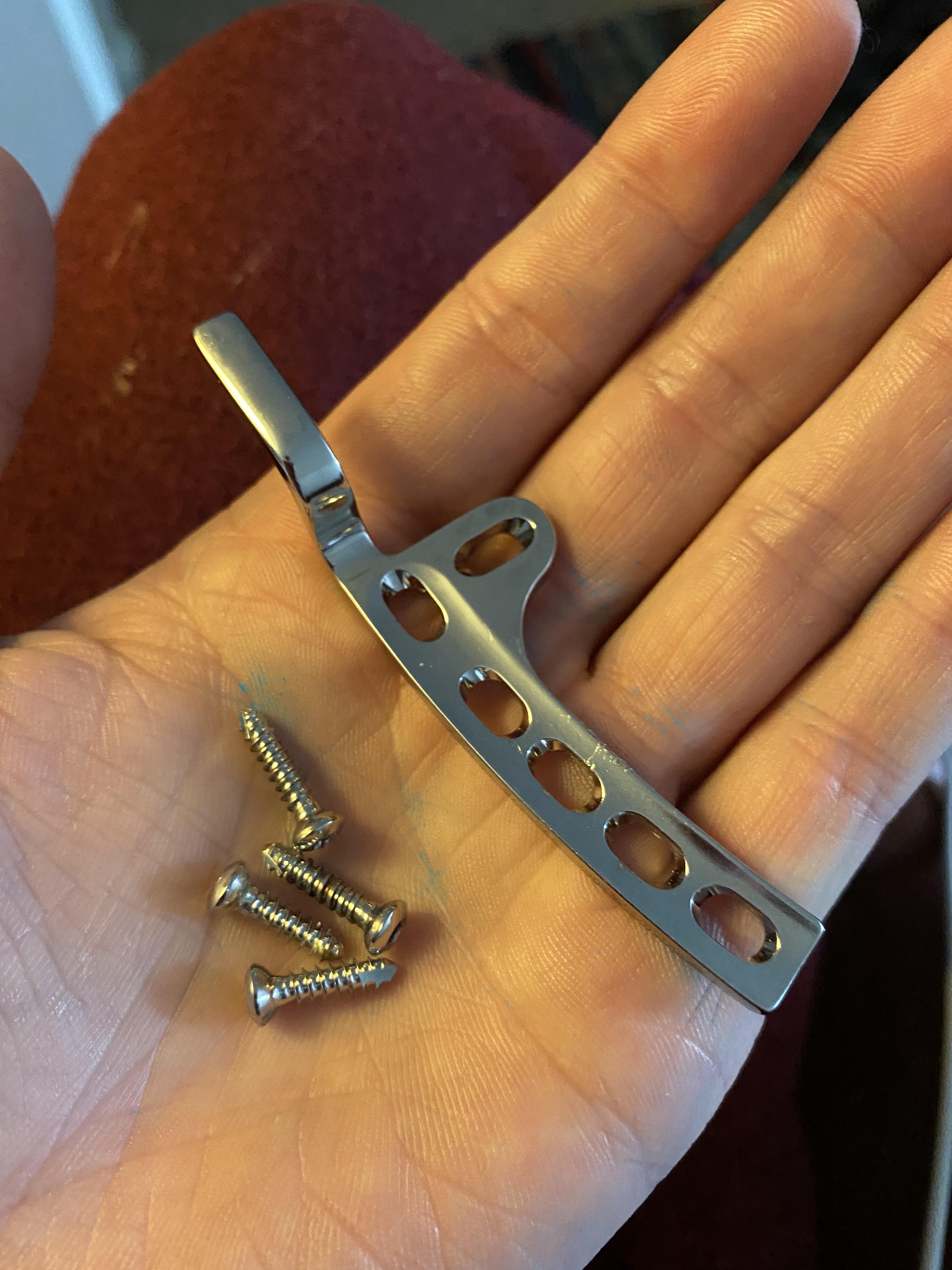 The surgeon gave back to me the plate and screws he removed from my ...