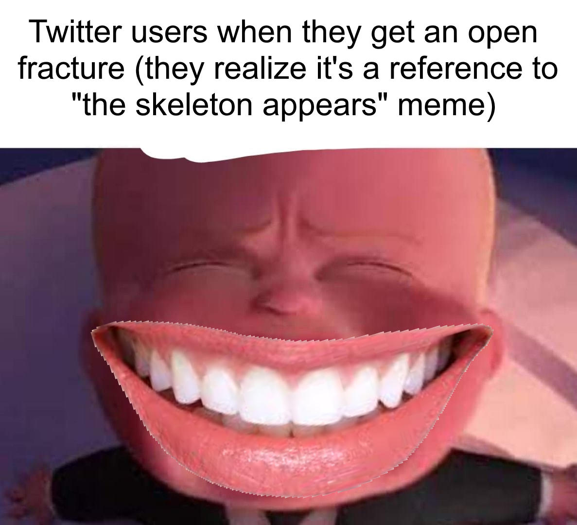 Twitter Users When They Get an Open Fracture | The Skeleton Appears ...