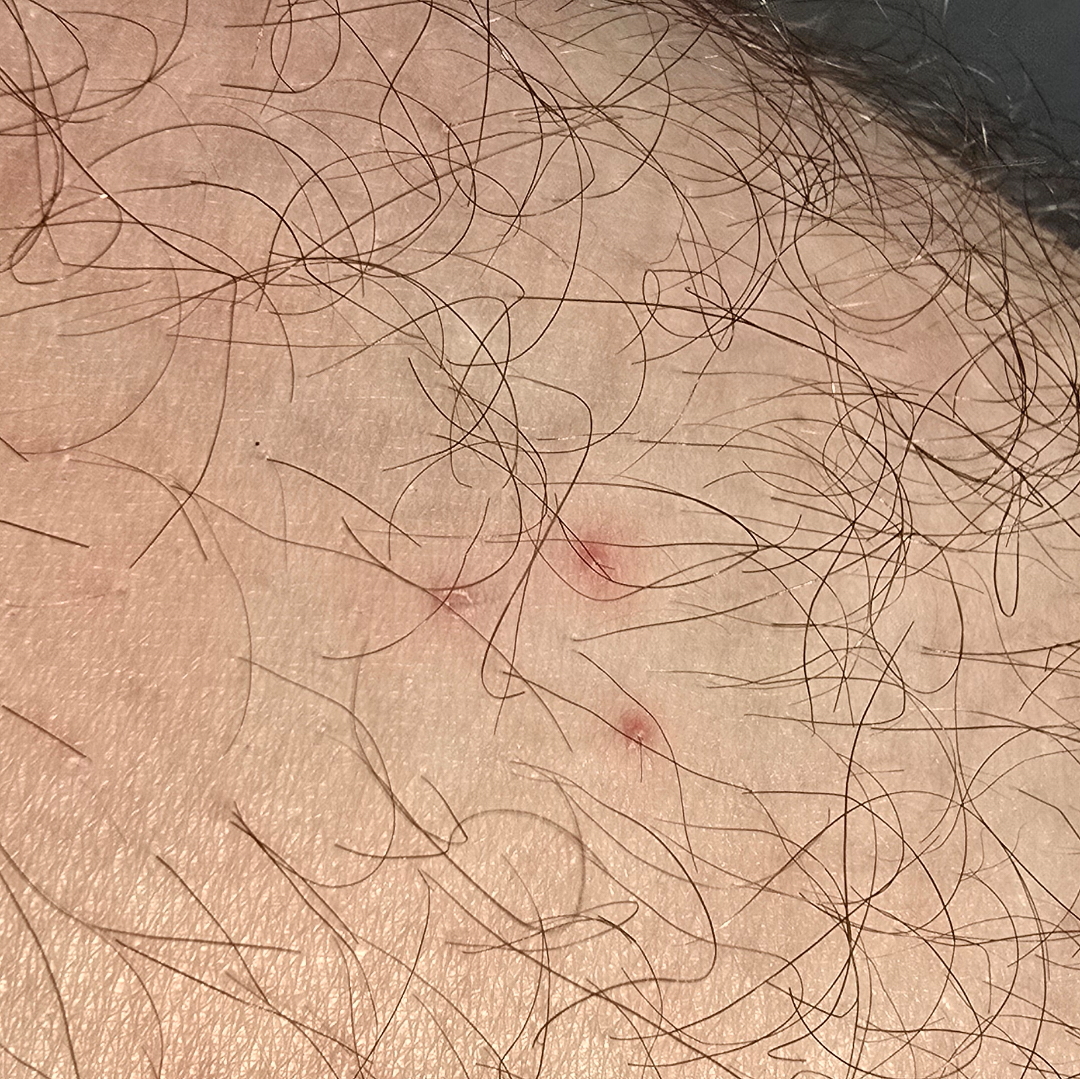 My friend got a weird bite on his leg... How do we tell him ? | /r ...